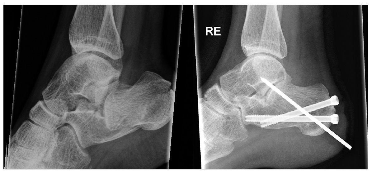 Reducción y fijación percutánea de las fracturas articulares de ...