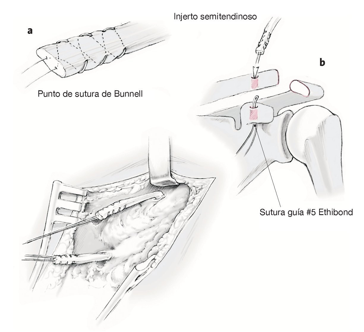 Problemática especial. Procedimiento para tratar un fracaso de la ...