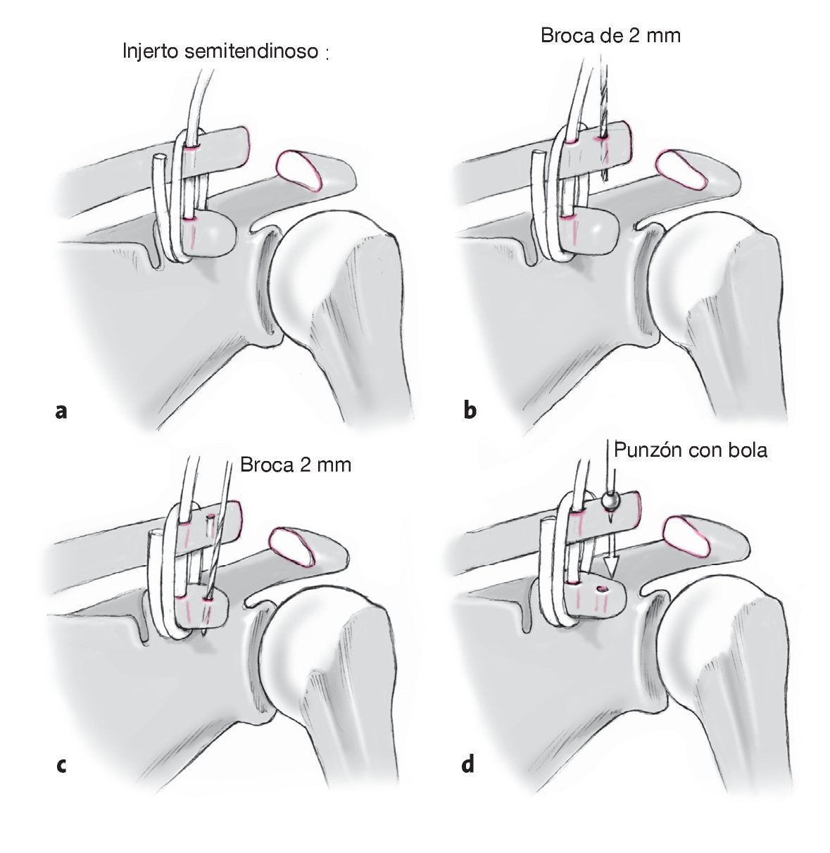 Problemática especial. Procedimiento para tratar un fracaso de la ...