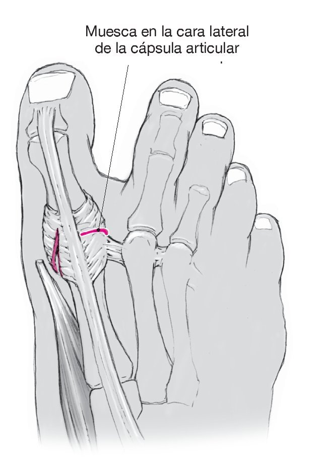 Hemitransposición del tendón del extensor largo en el tratamiento del ...