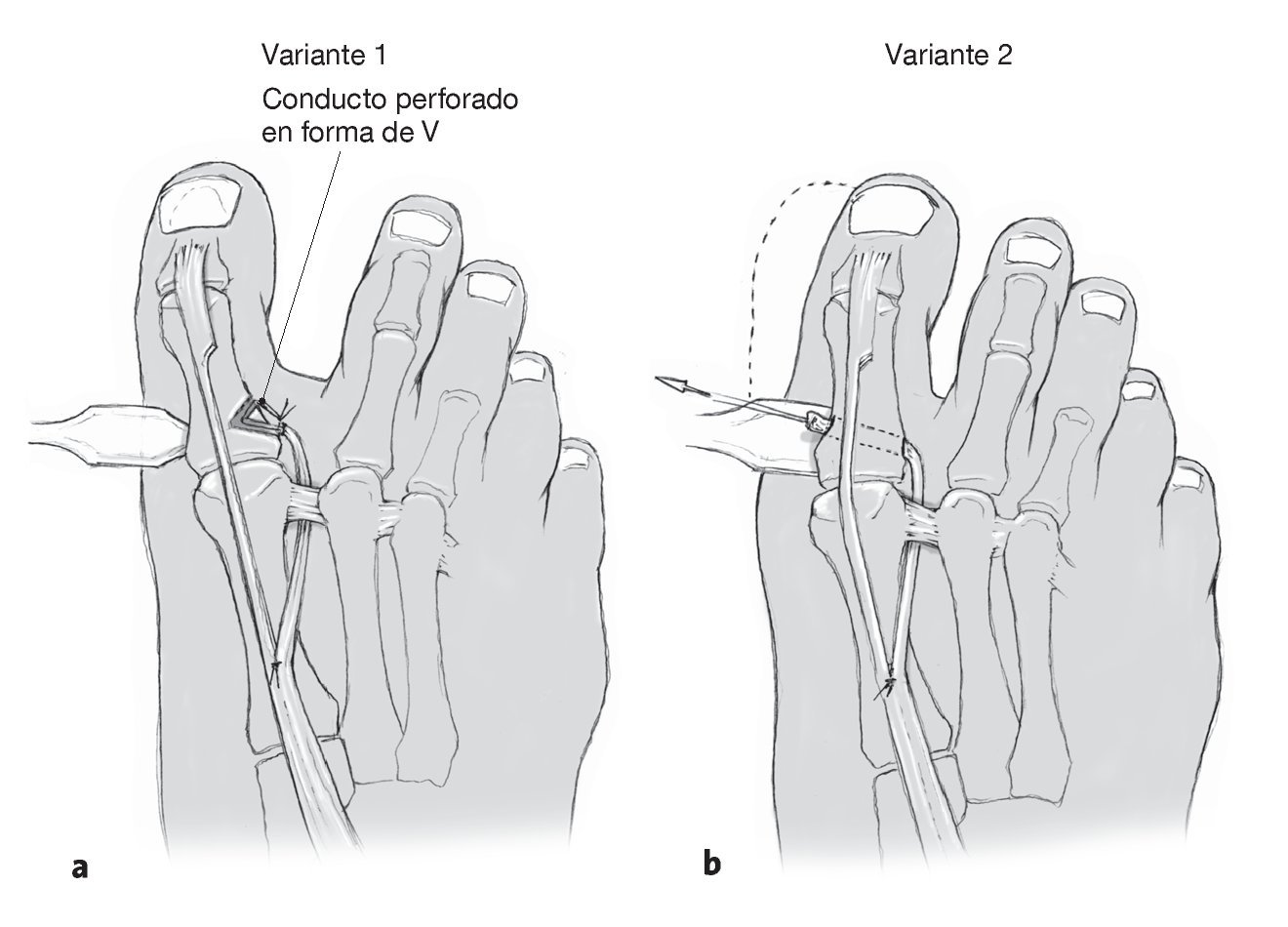 Hemitransposición del tendón del extensor largo en el tratamiento del ...