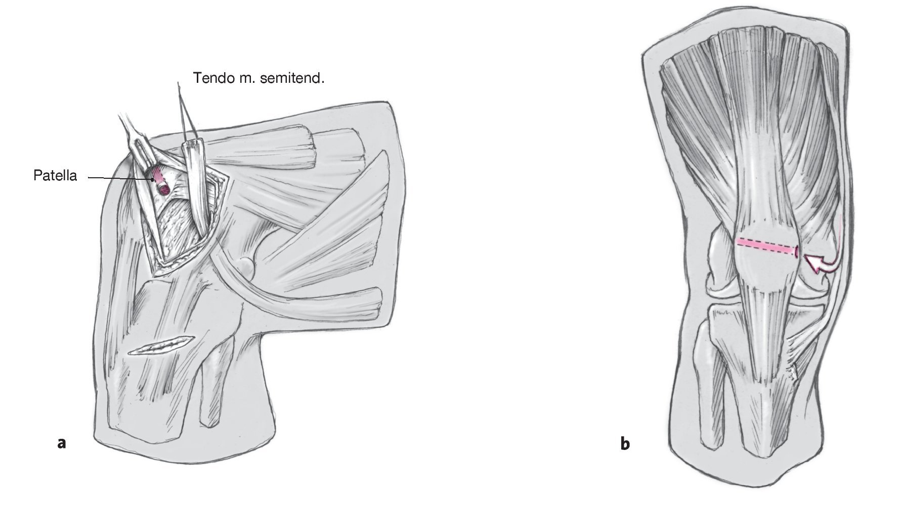 Reconstrucción del ligamento femoropatelar medial mediante la ...