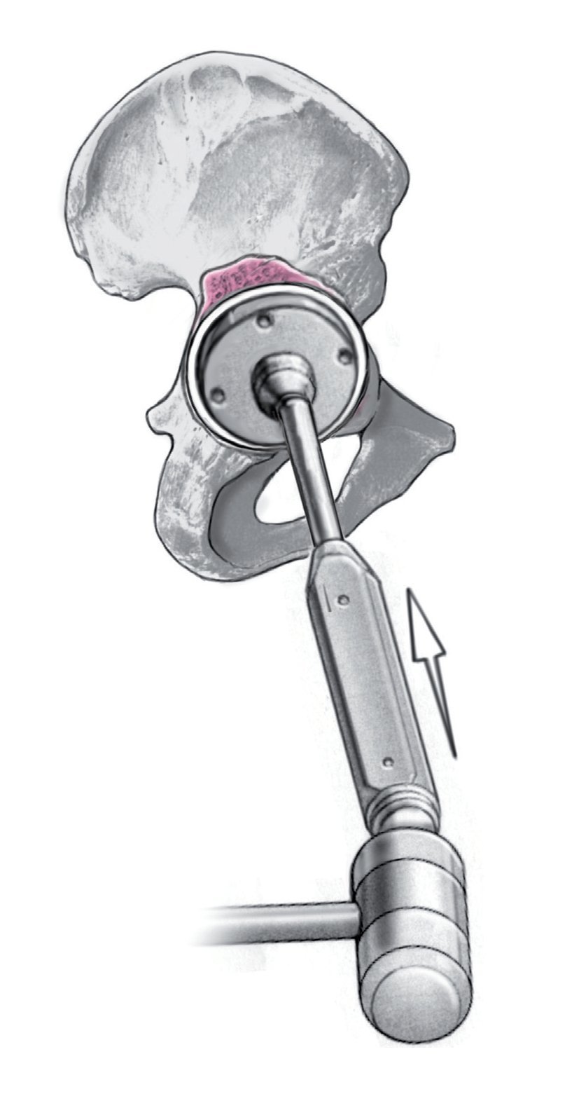 Técnica de implantación de un cótilo no cementado pressfit en ...