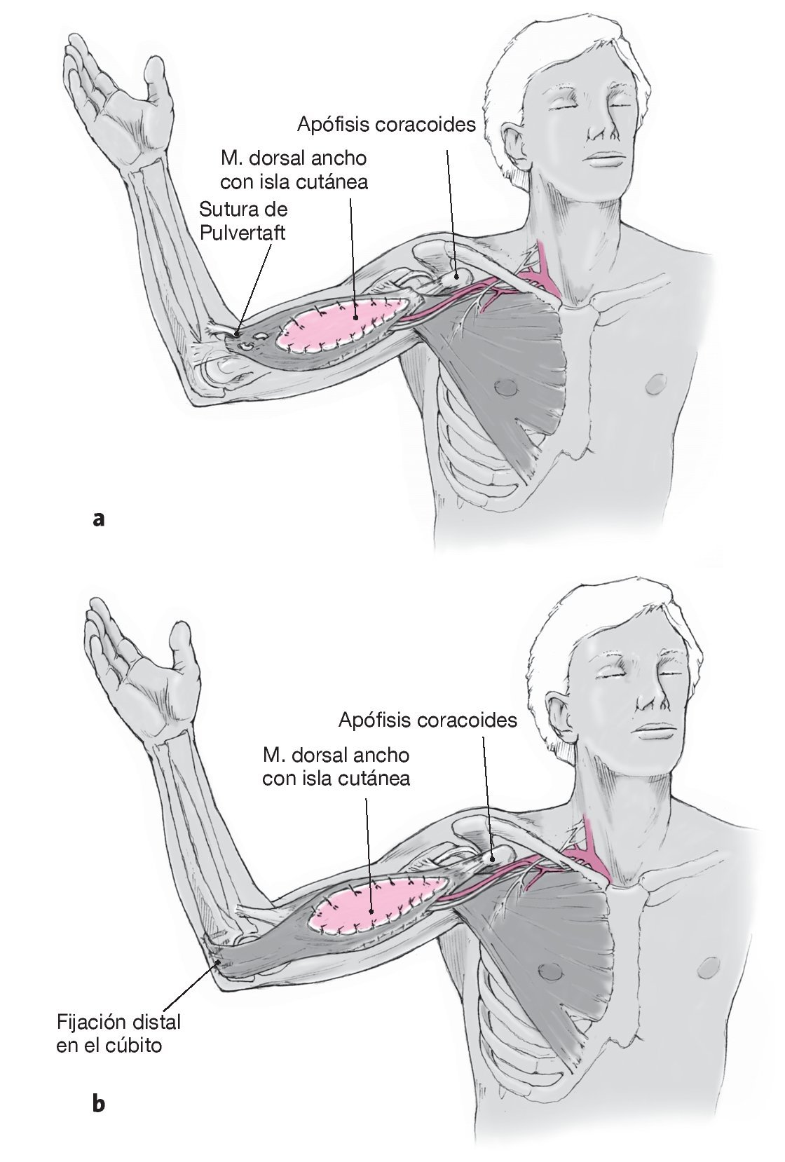Reconstrucción de la flexión activa del codo por transposición bipolar ...