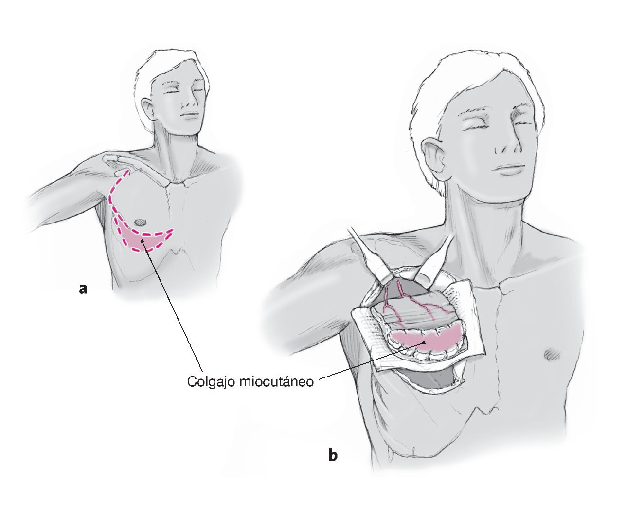Trasplante del músculo pectoral mayor para el restablecimiento de la ...