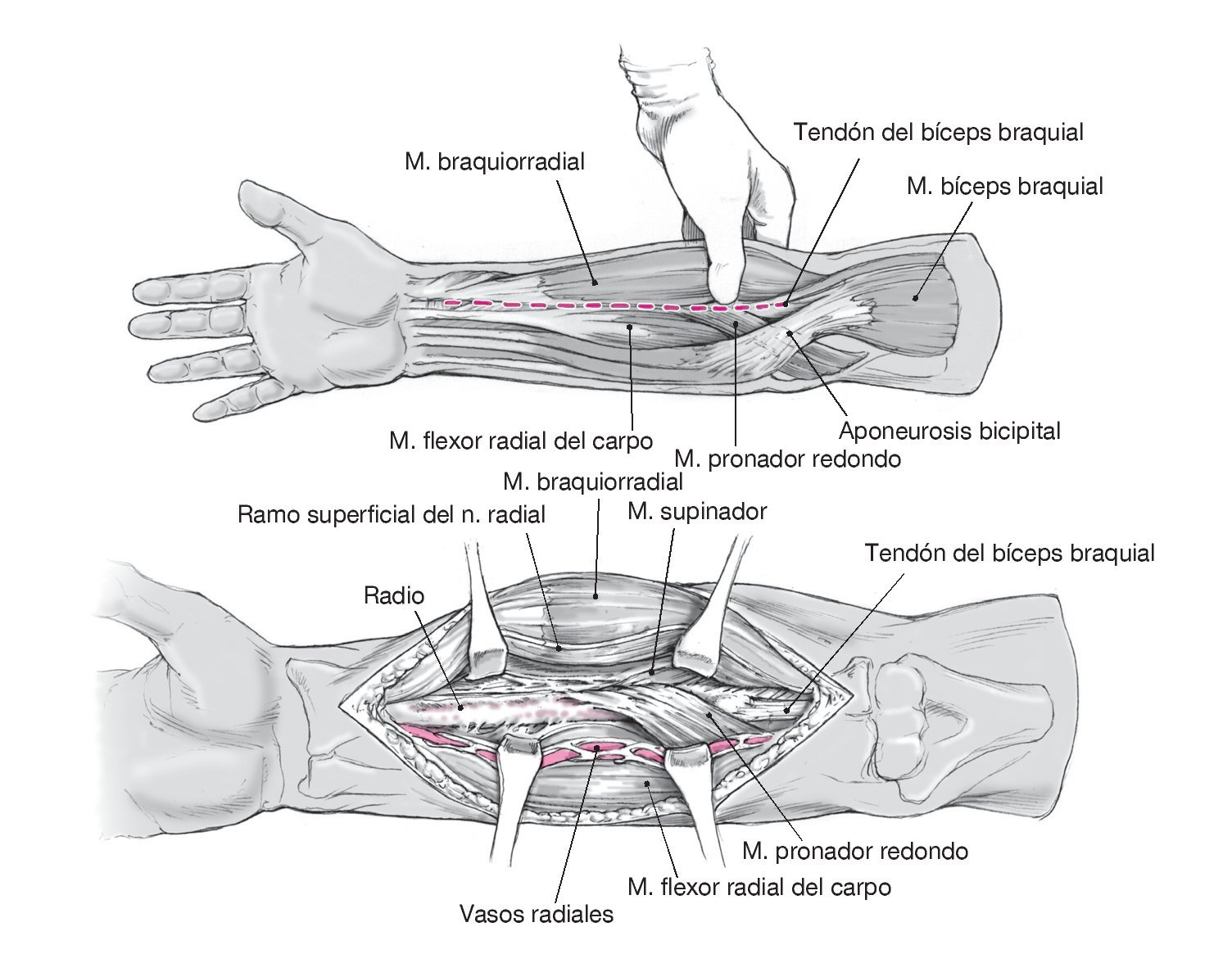 Plastia en Z y reorientación del tendón del bíceps con liberación de la ...