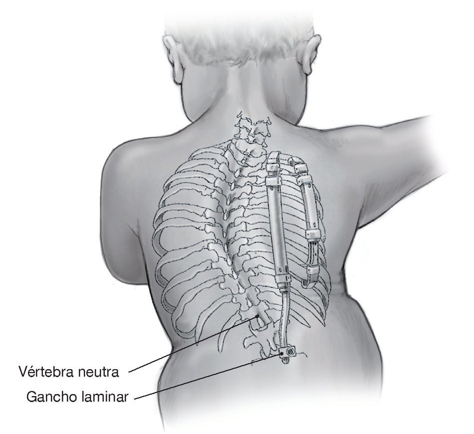 Tratamiento quirúrgico de las escoliosis con la prótesis costal ...