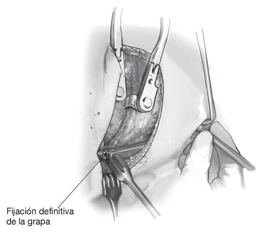 Tratamiento quirúrgico de las escoliosis con la prótesis costal ...