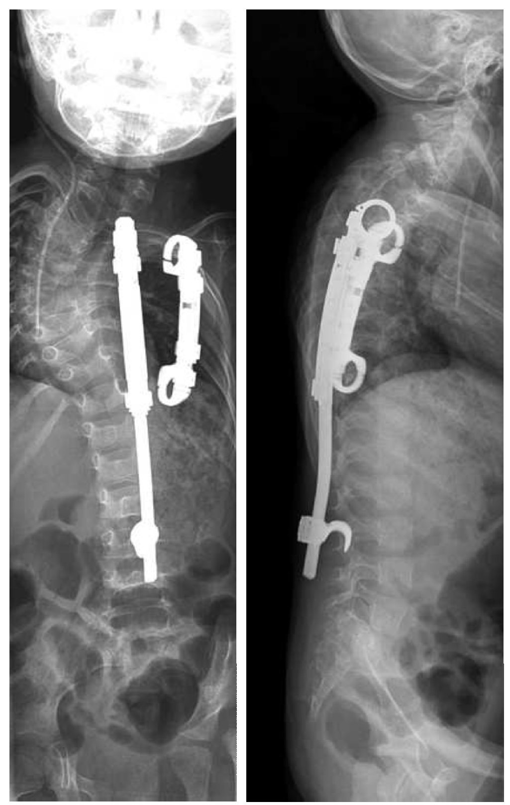 Tratamiento quirúrgico de las escoliosis con la prótesis costal ...