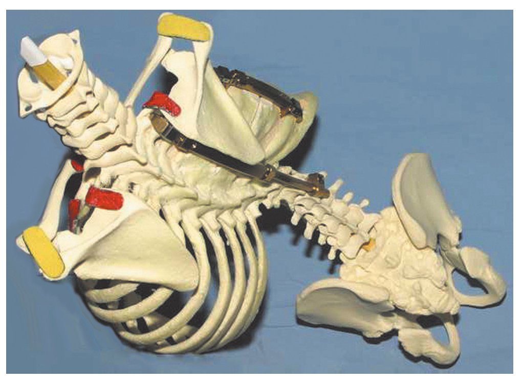 Tratamiento quirúrgico de las escoliosis con la prótesis costal ...