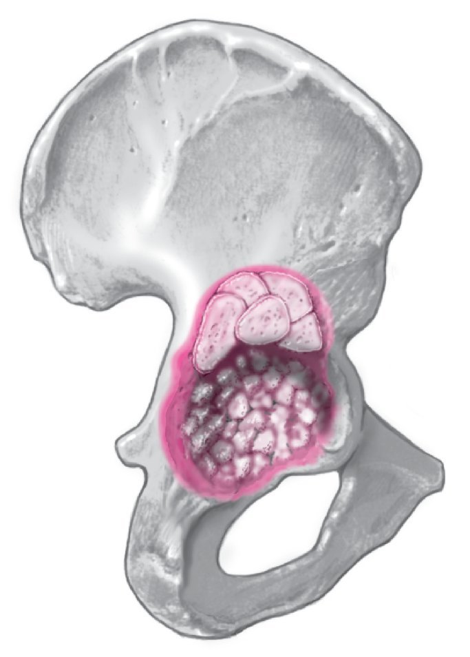 Recambio acetabular con anillos antiprotrusión en defectos de mayor ...