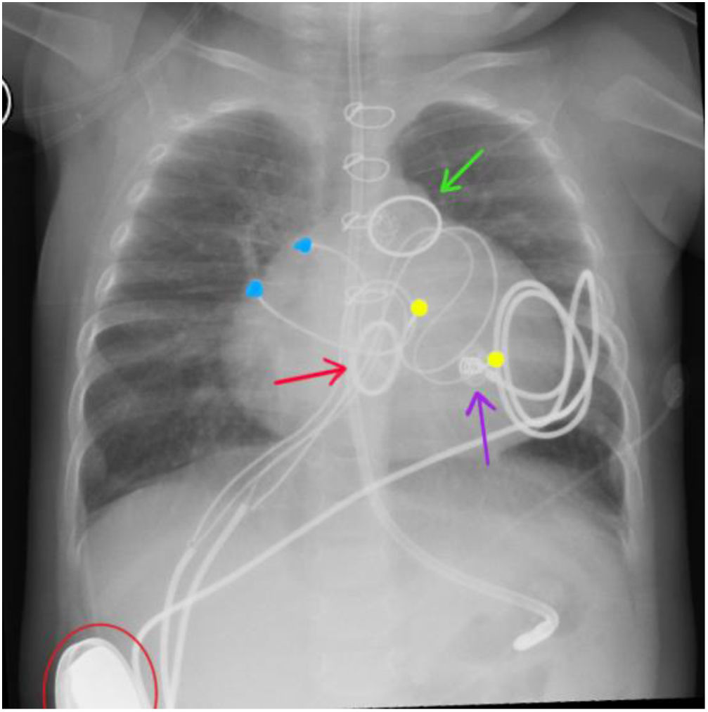 Procedimiento de Ross-Konno más reemplazo valvular mitral neonatal tras ...