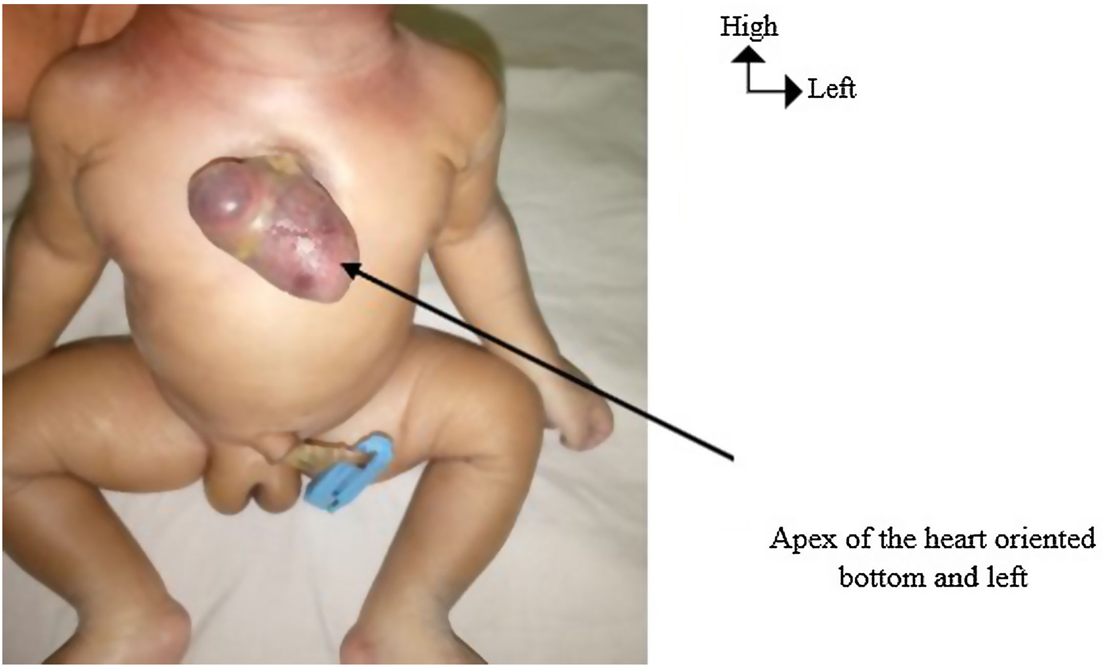 ectopia cordis interna