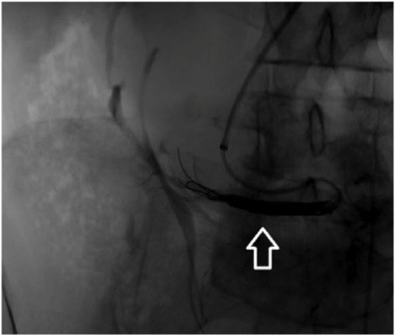 Chimney/snorkel endovascular aneurysm repair (ChEVAR) of an abdominal ...