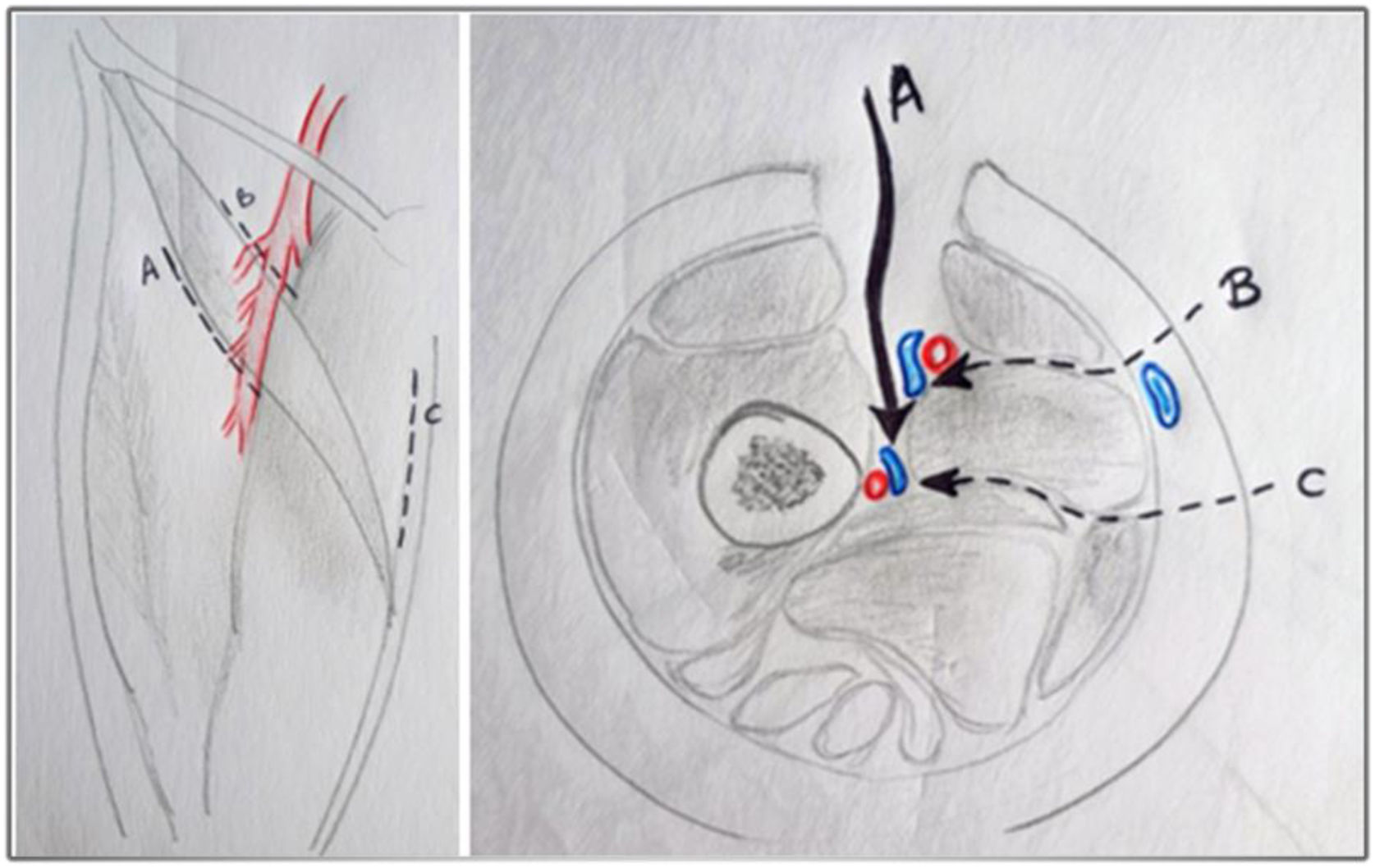 Abordaje quirúrgico de las arterias de las extremidades inferiores ...