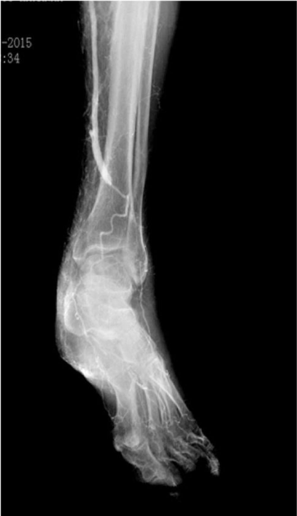 Técnicas de revascularización femoropoplíteas y distales | Cirugía ...