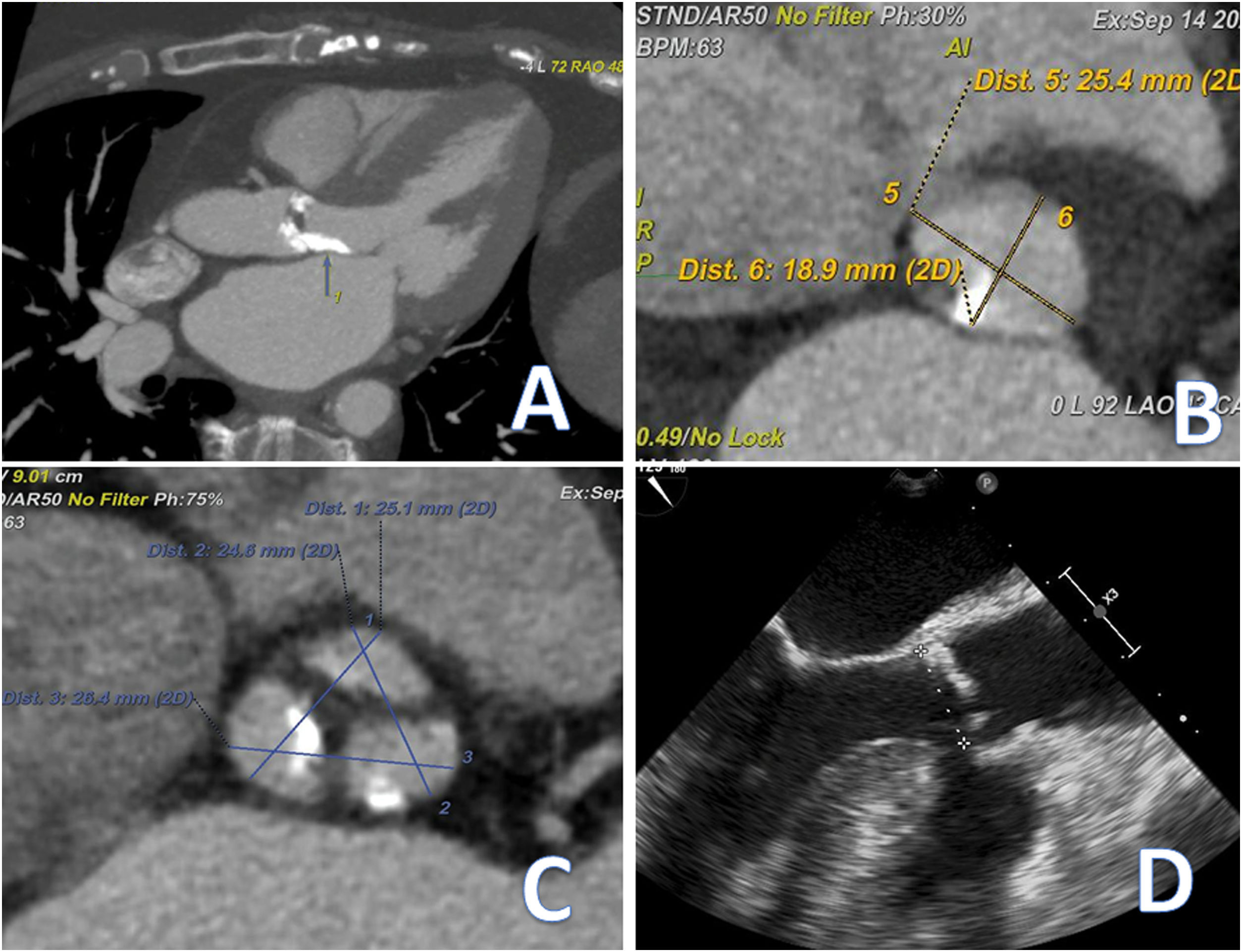 Yang aortic root enlargement through ministernotomy in an obese patient ...