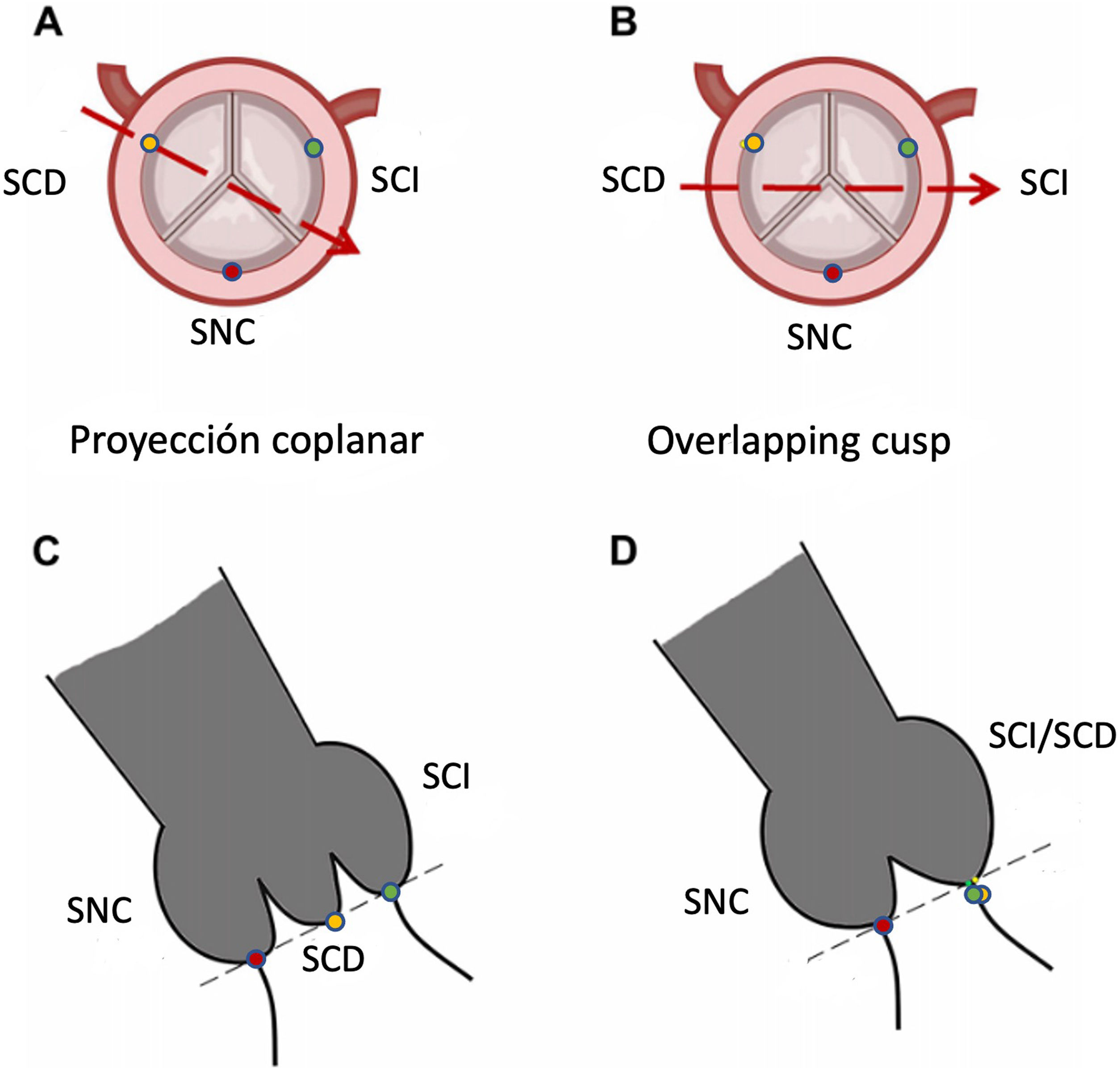 TAVI Implante Coplanar Vs Overlapping cusp Cirug a Cardiovascular TAVI Implante Coplanar Vs Overlapping cusp Cirug a Cardiovascular