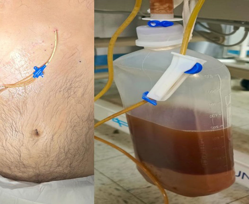 Surgical management of purulent pericarditis by Morganella morganii ...