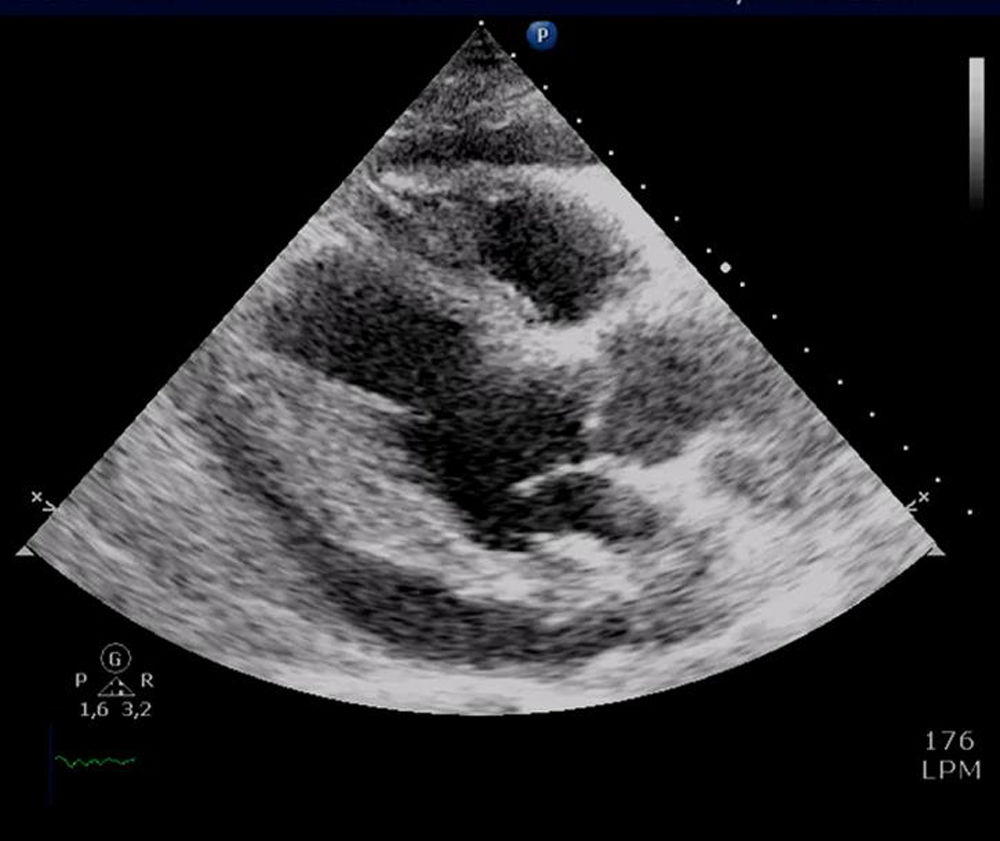 Derrame pericárdico maligno. A propósito de un caso | Cirugía ...