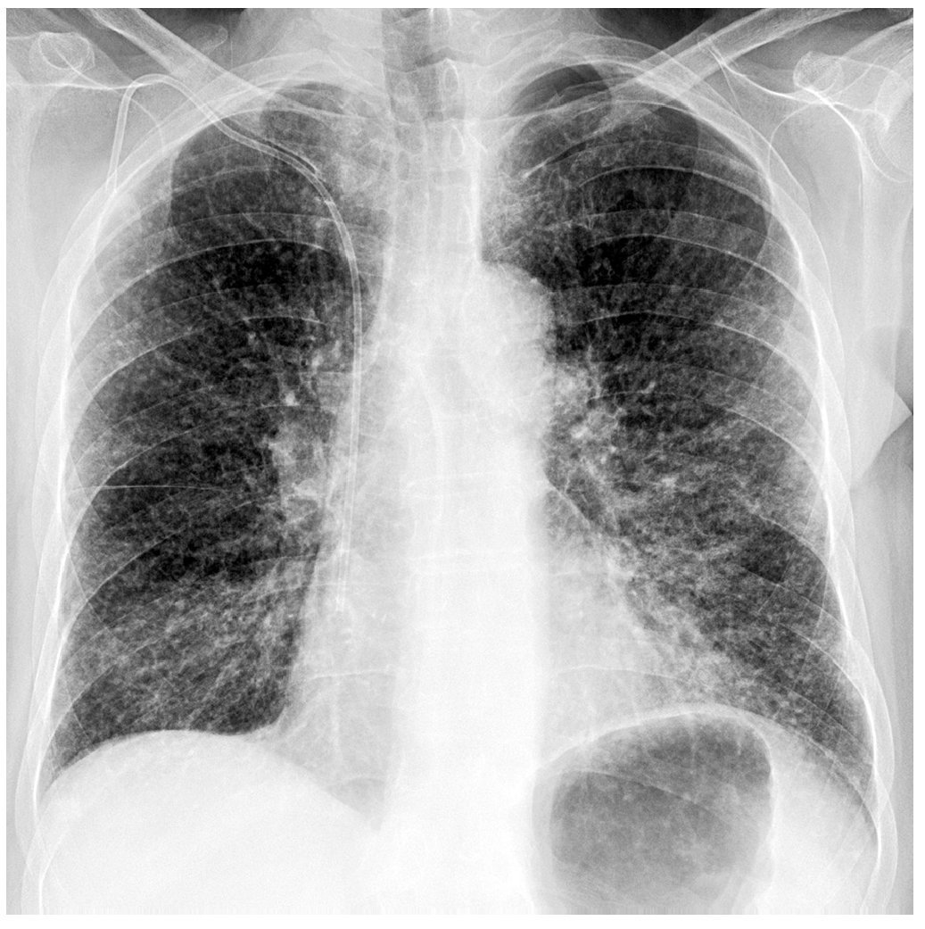 Capítulo 2. Patrón alveolar, intersticial, mixto y lesiones ...