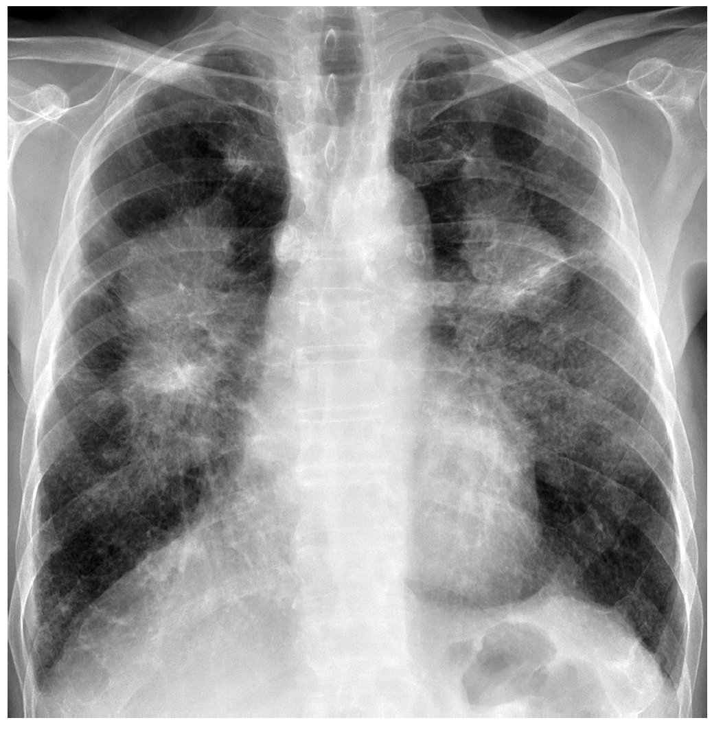 Capítulo 2. Patrón alveolar, intersticial, mixto y lesiones ...