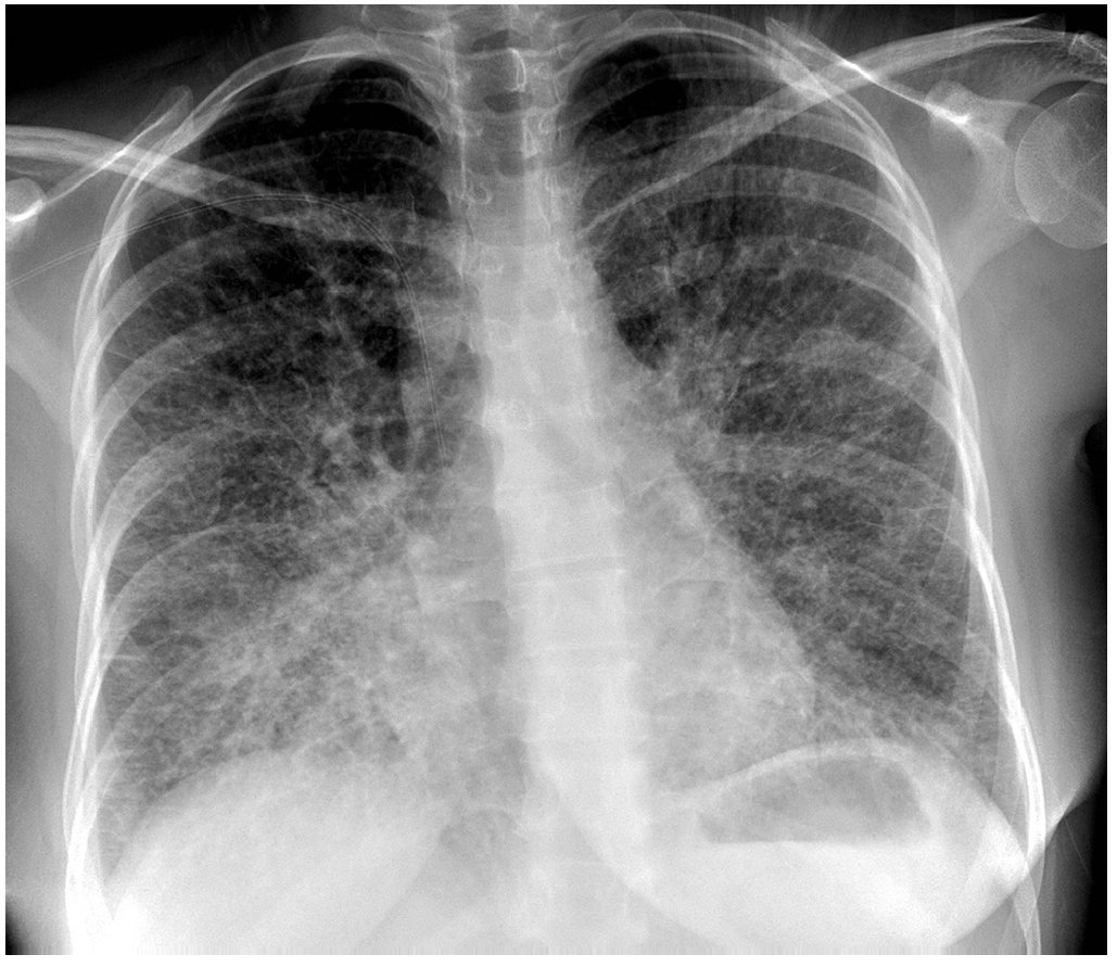 Capítulo 2. Patrón alveolar, intersticial, mixto y lesiones ...