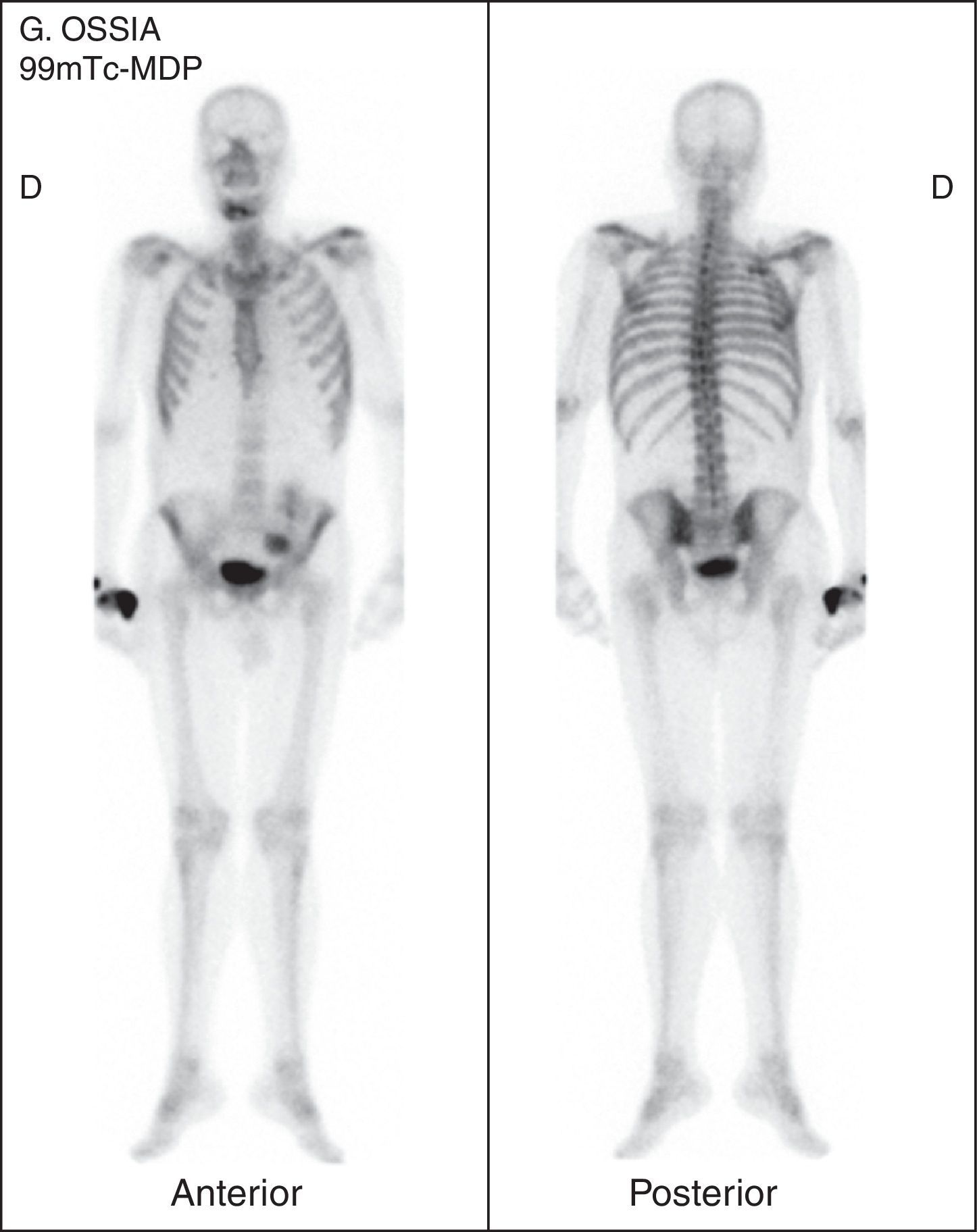 Numb chin syndrome o neuropatía del nervio mentoniano como primera ...