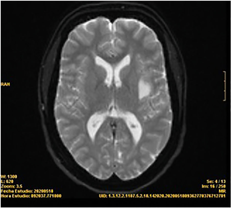 The role of the insula: Diagnosis of a brain tumor in a patient with ...