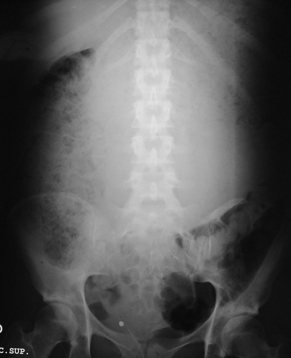 Dolor abdominal en paciente con bulimia nerviosa | Medicina de Familia ...