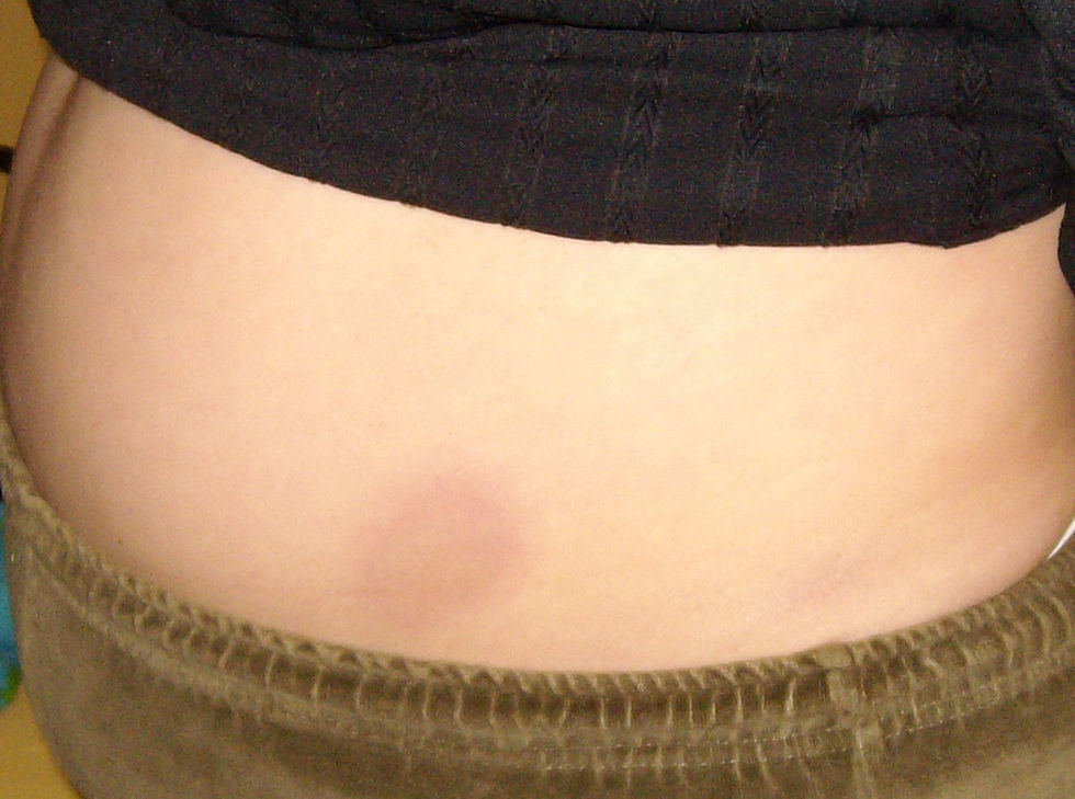 Esclerosis cutánea localizada (morfea), a propósito de un caso ...