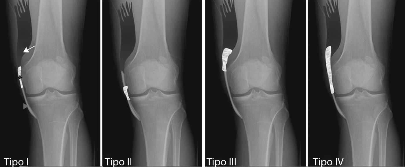 Síndrome de Pellegrini-Stieda como causa de gonalgia | Medicina de ...