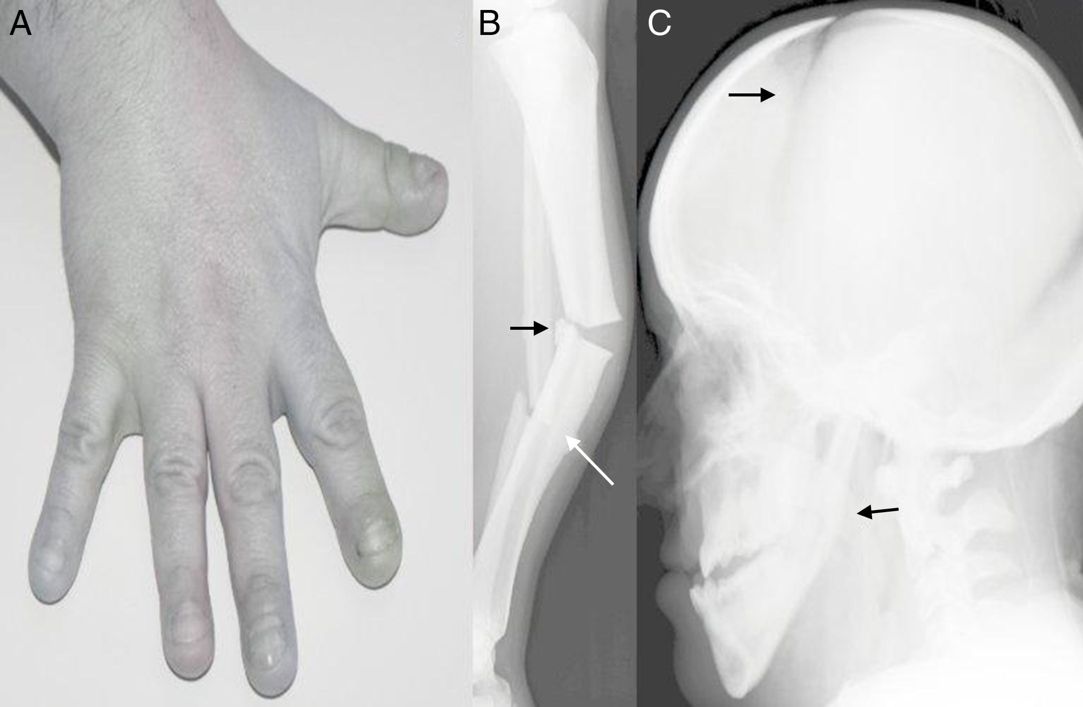 Picnodisostosis: una rara enfermedad con fracturas frecuentes ...