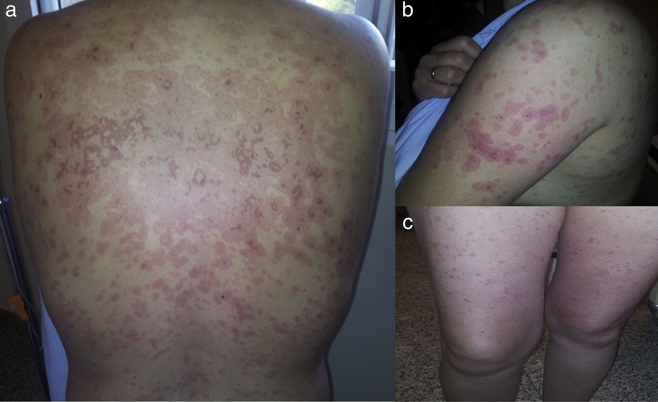 Infección Por Anisakis – Anisakiasis España – GIAU