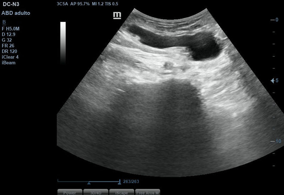 Quiste de Nuck: un caso clínico en atención primaria | Medicina de ...