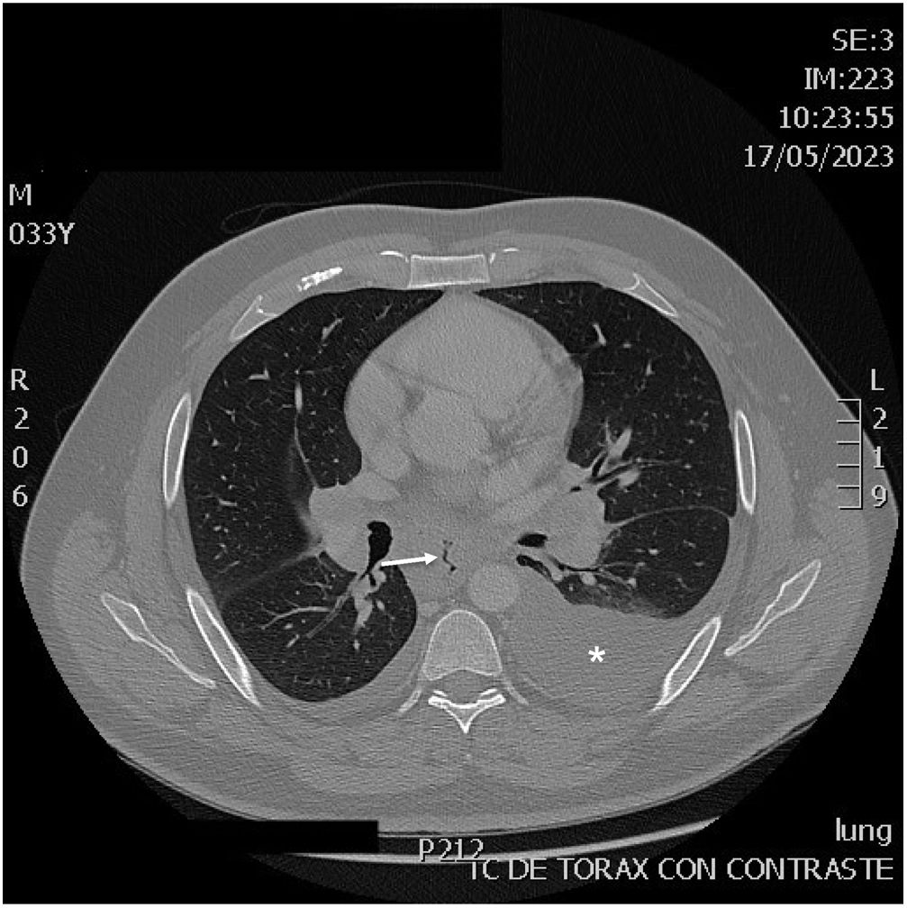 Sintomatología esofágica como síntoma guía de tuberculosis ganglionar ...