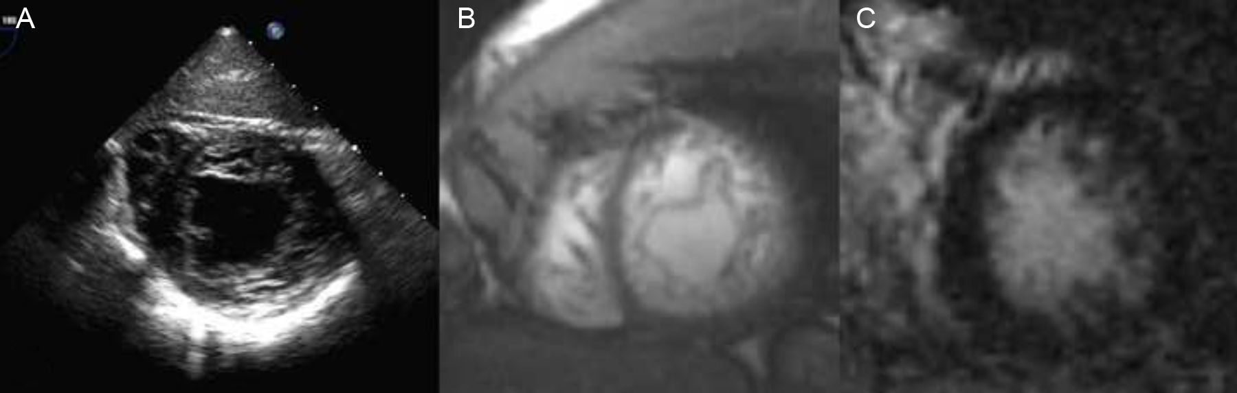 Left ventricle non-compaction cardiomyopathy: Different clinical ...