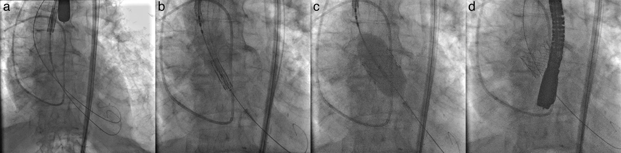 “Buddy wire” technique in transcatheter aortic valve implantation with ...