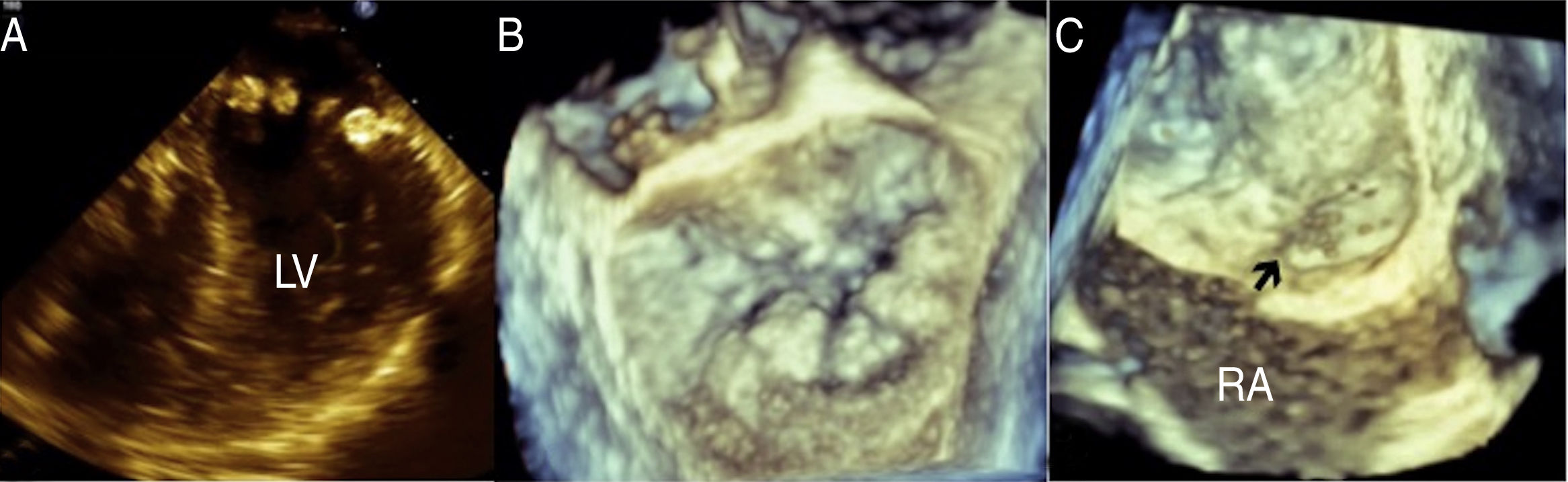 An unusual association of hypertrophic obstructive cardiomyopathy ...