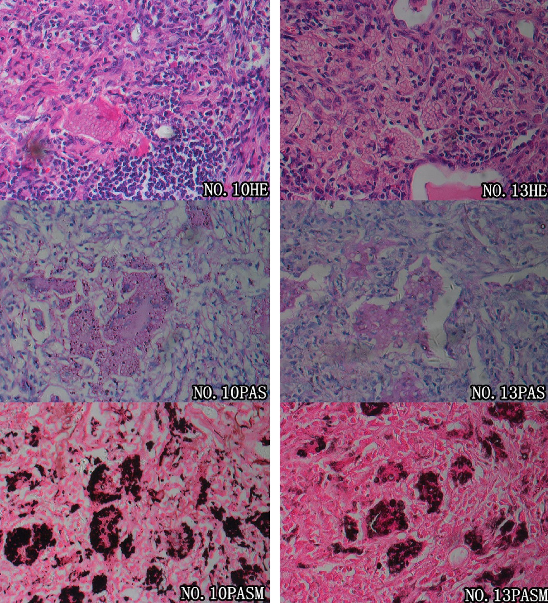 cryptococcus lung histology