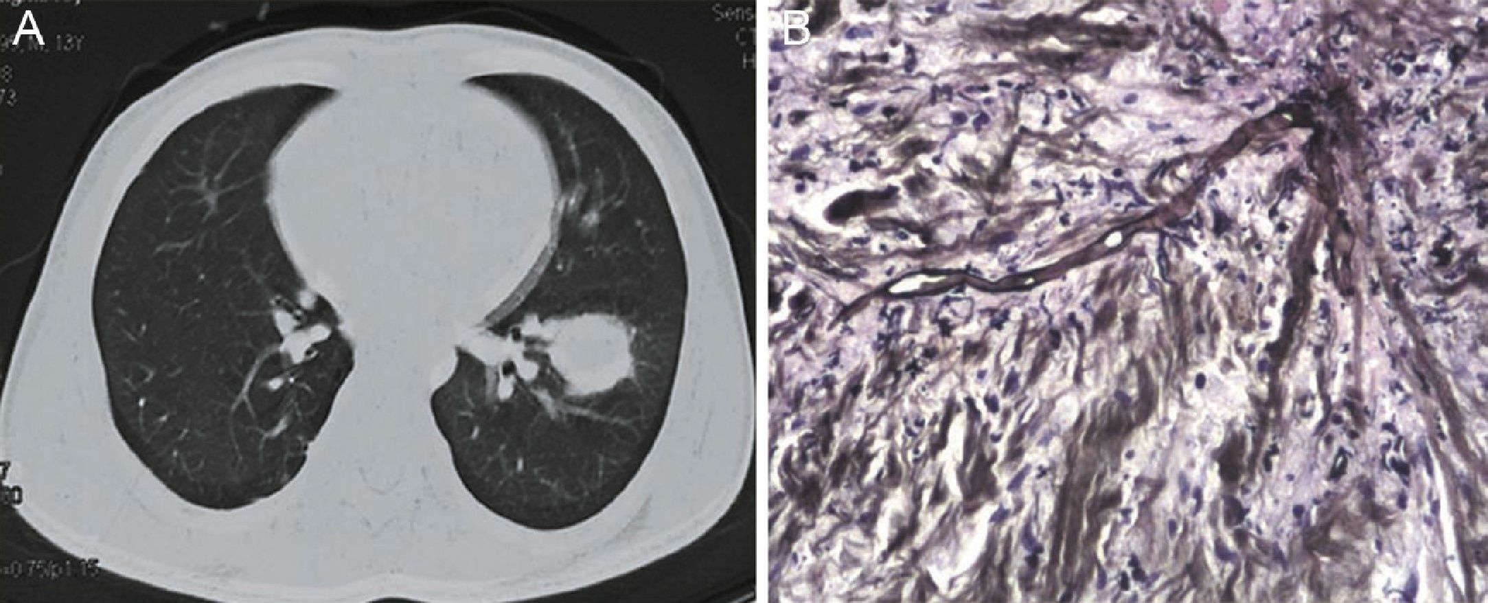 pulmonary mucormycosis case report