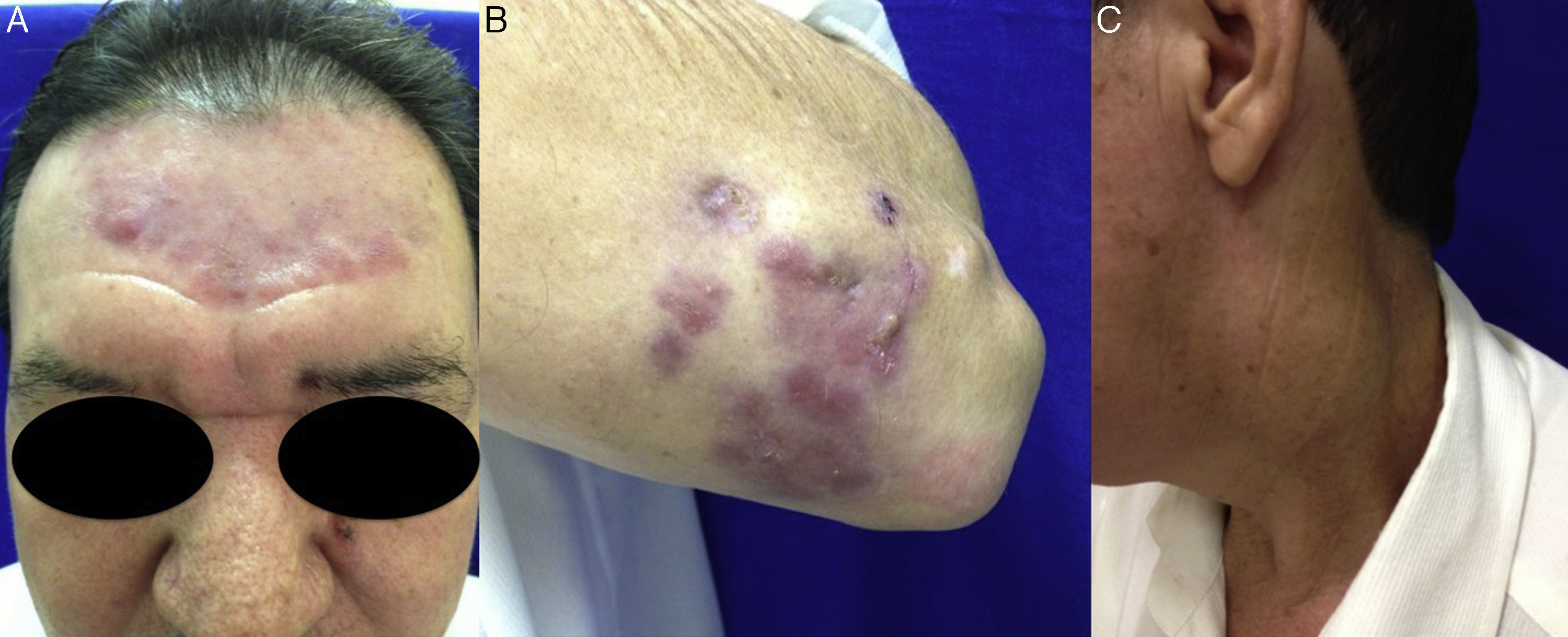 tertiary syphilis photos