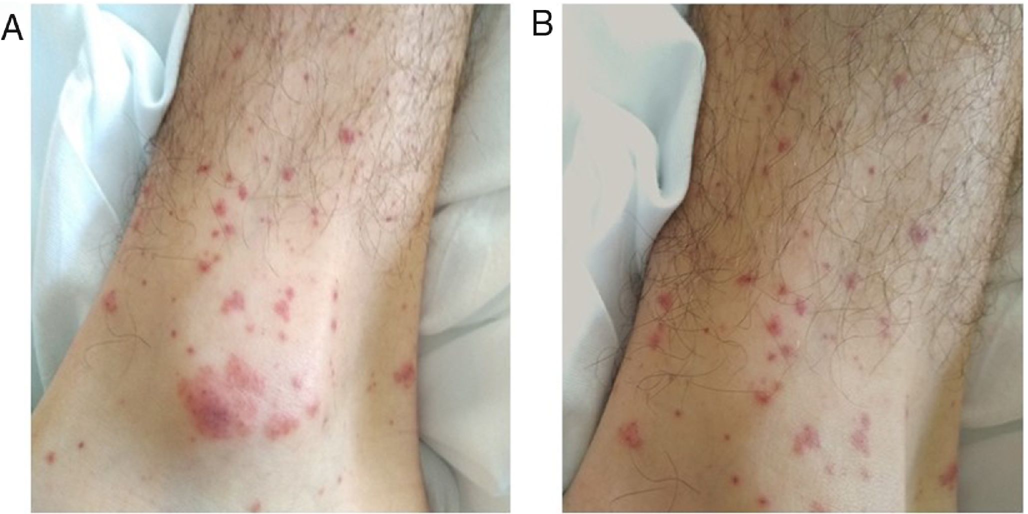 A 19-year old man with IgA vasculitis after vaccination | The Brazilian ...