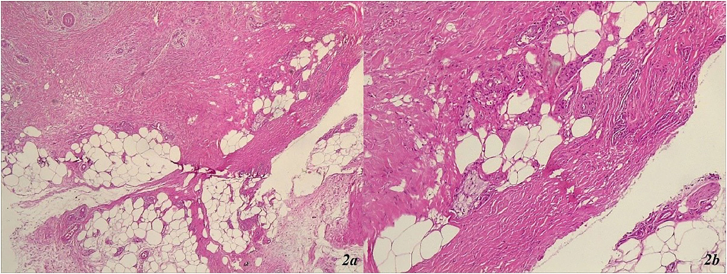 Erythema nodosum as first clinical sign of acute Borrelia burgdorferi ...