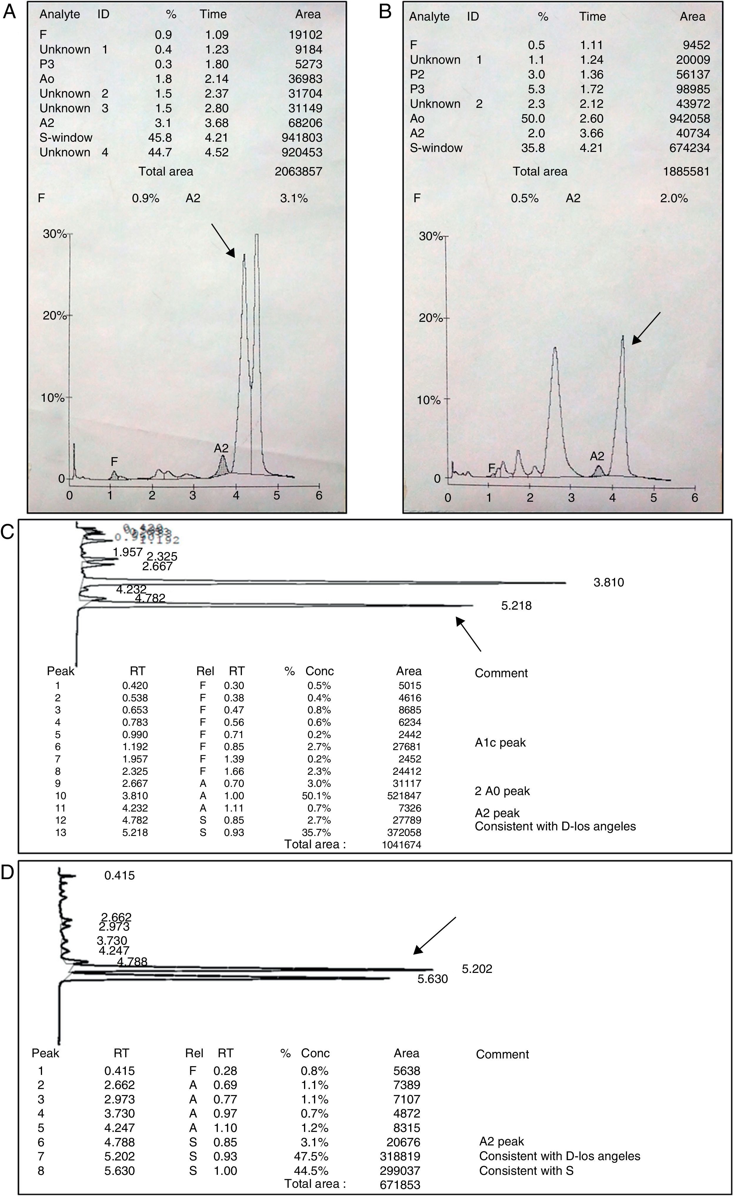 haemoglobin sd