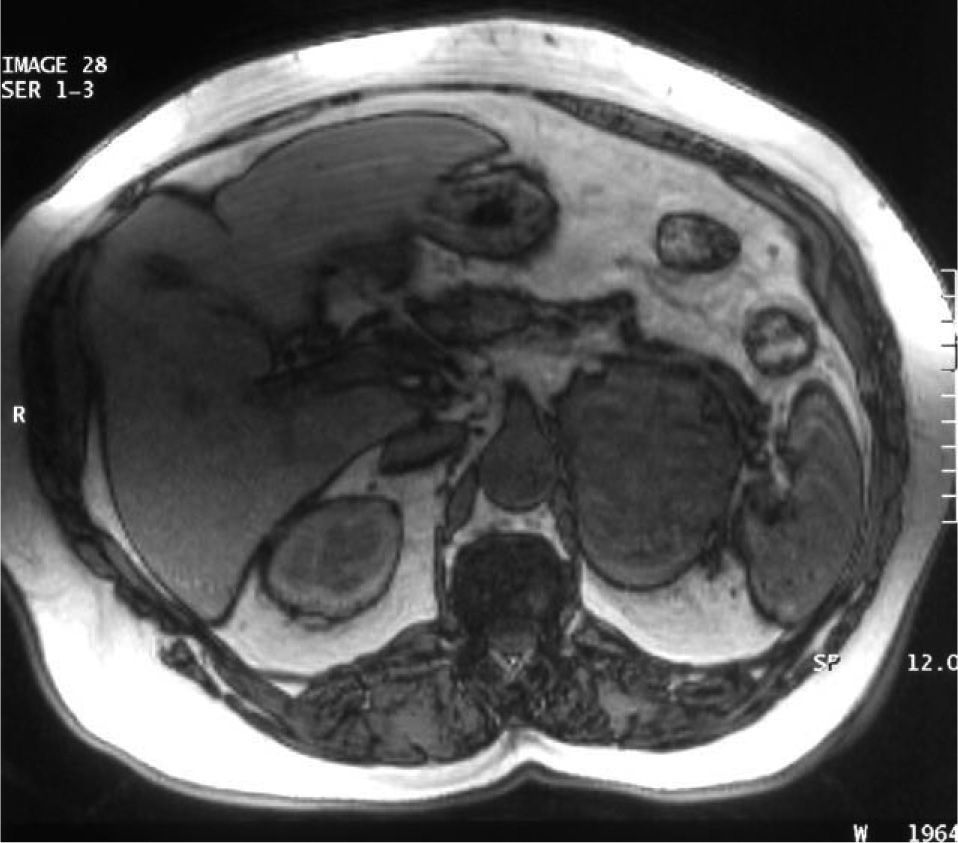 Virilización en una mujer posmenopáusica. Consideraciones diagnósticas ...