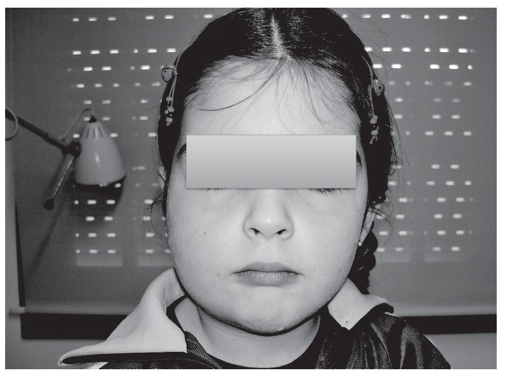 Tumefacción parotídea posvacuna triple vírica | Vacunas