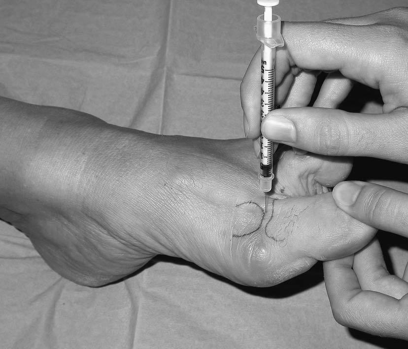 Artrocentesis de la primera articulación metatarsofalángica ...