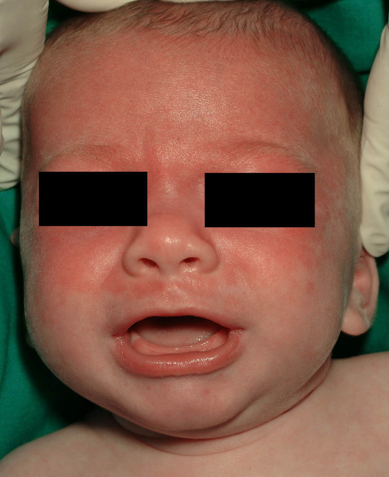 Lupus eritematoso neonatal | Seminarios de la Fundación Española de ...