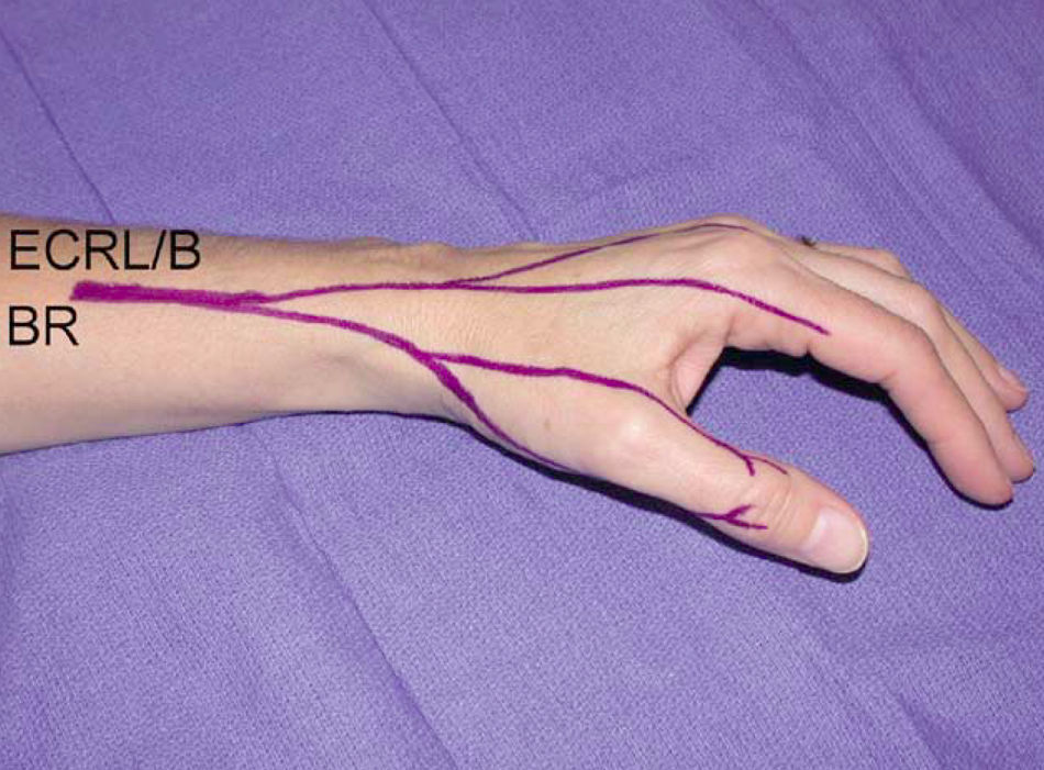 Síndrome de Wartenberg | Seminarios de la Fundación Española de ...